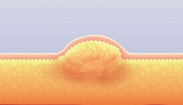 Let’s Rotate – Improve Diabetes Injection Site Rotation – Steady Shot ...
