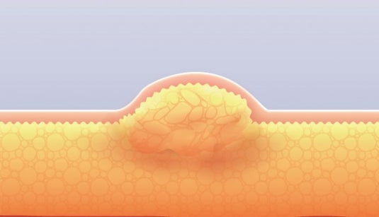 Let’s Rotate – Improve Diabetes Injection Site Rotation – Steady Shot ...